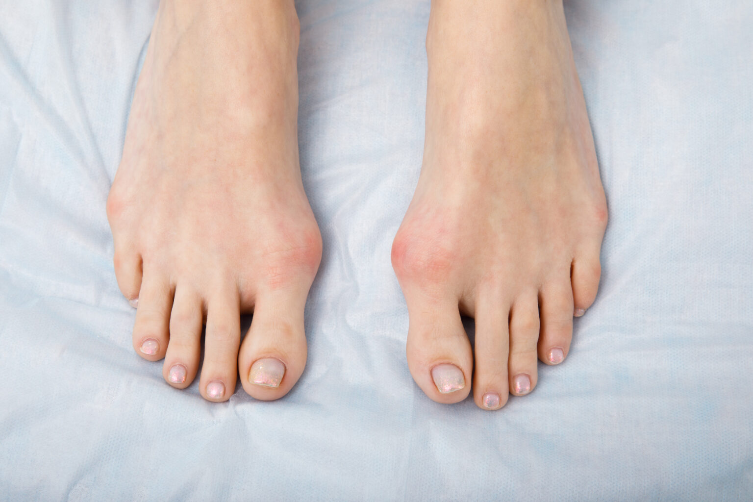 Bunion Correction | Alpine Foot Specialists
